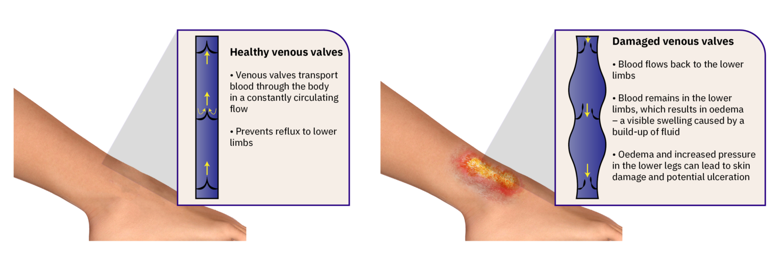 Venous Leg Ulcer Treatment | Guidelines & Compression Therapy