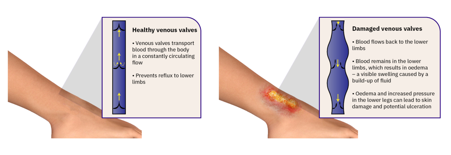 Guiding to venous leg ulcer management and compression therapy