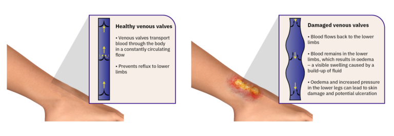 Guiding to venous leg ulcer management and compression therapy