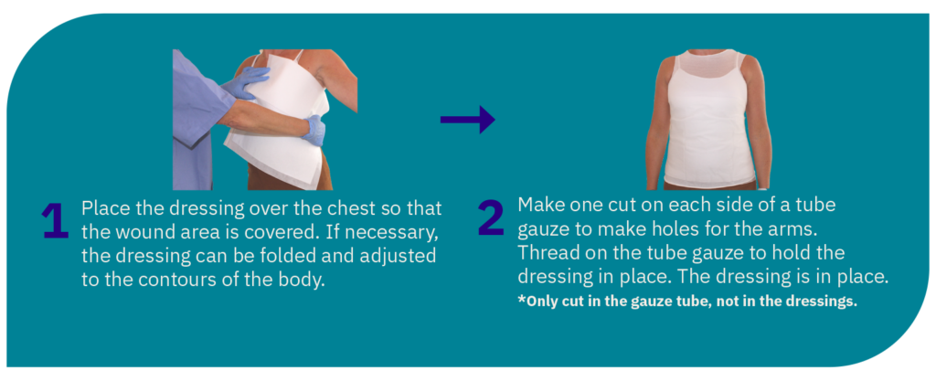 A folding guide for wound dressings | Wound management