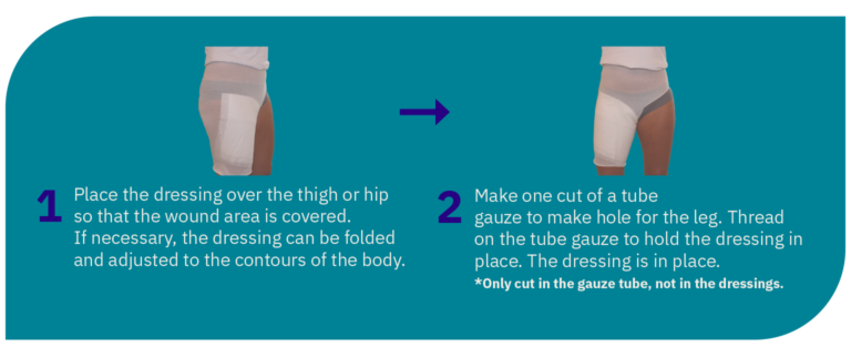 A folding guide for wound dressings | Wound management