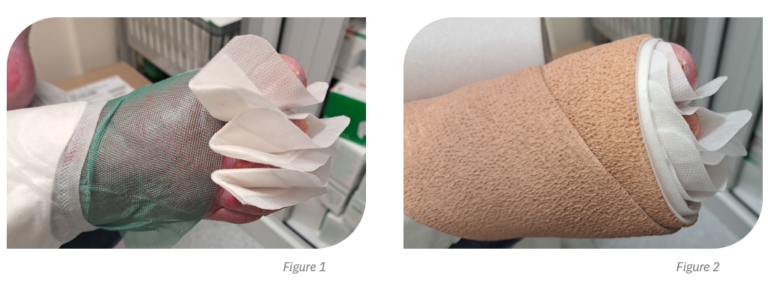 Management Toe Leg Lymphorrhoea | Compression | Leaking legs